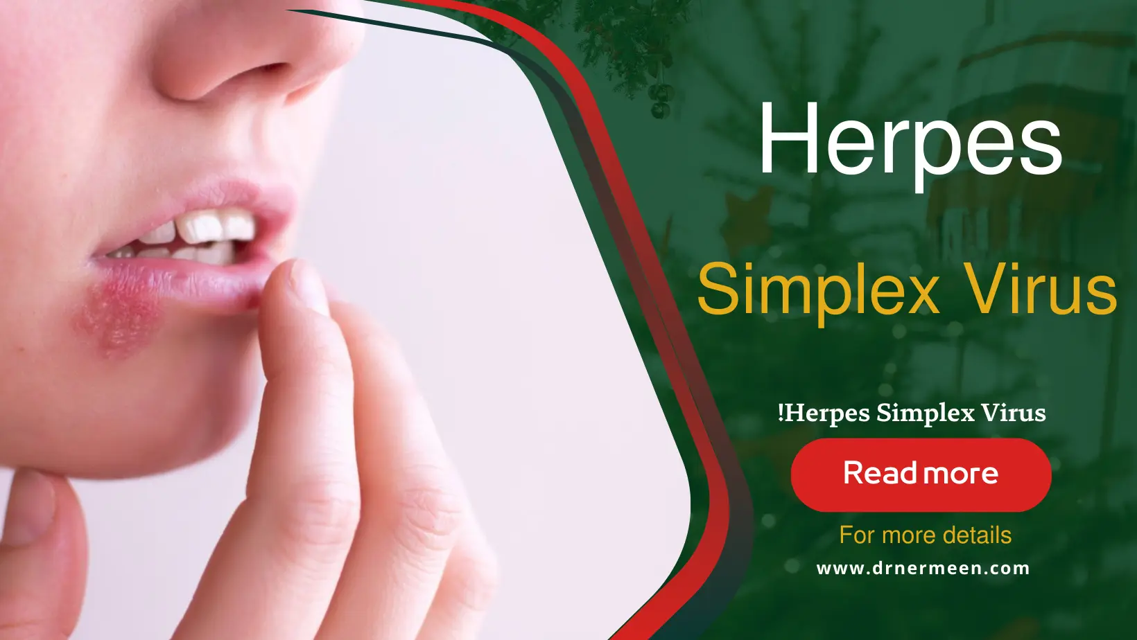Herpes Simplex Virus (HSV) - دكتور نرمين
