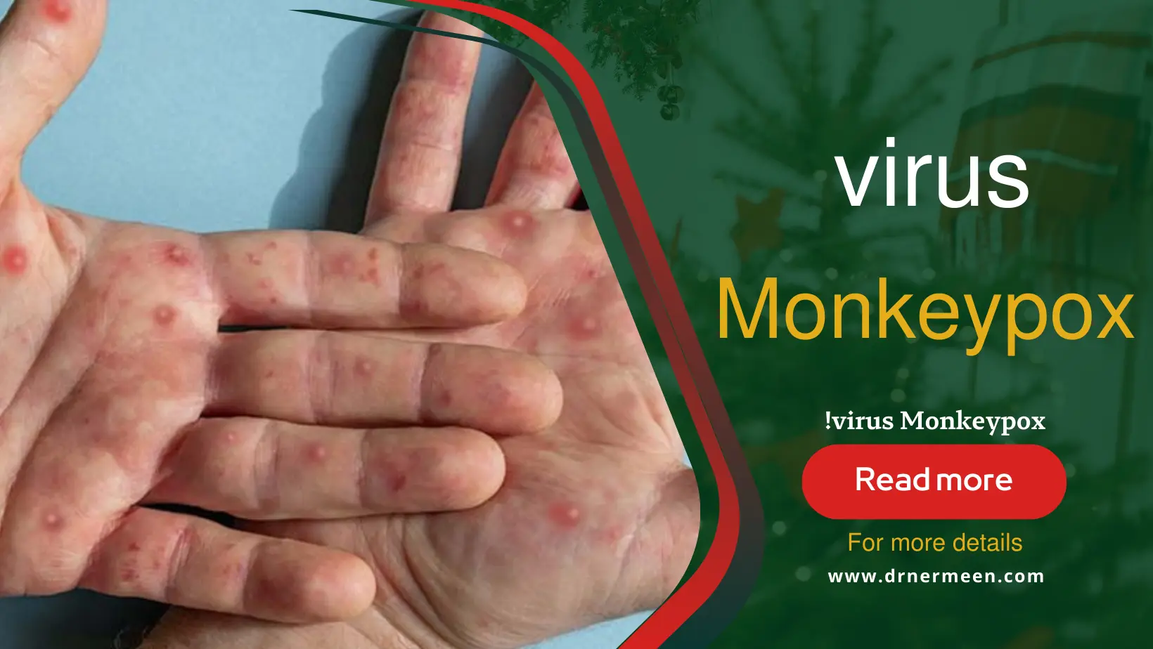 Monkeypox: A Comprehensive Guide - دكتور نرمين